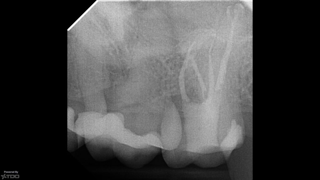 A Cracked Molar. Ouch! - Lake Washington Endo