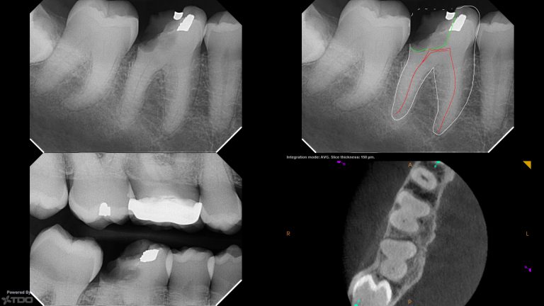 Root Canal Treatment on a Severely Calcified Tooth - Lake Washington Endo