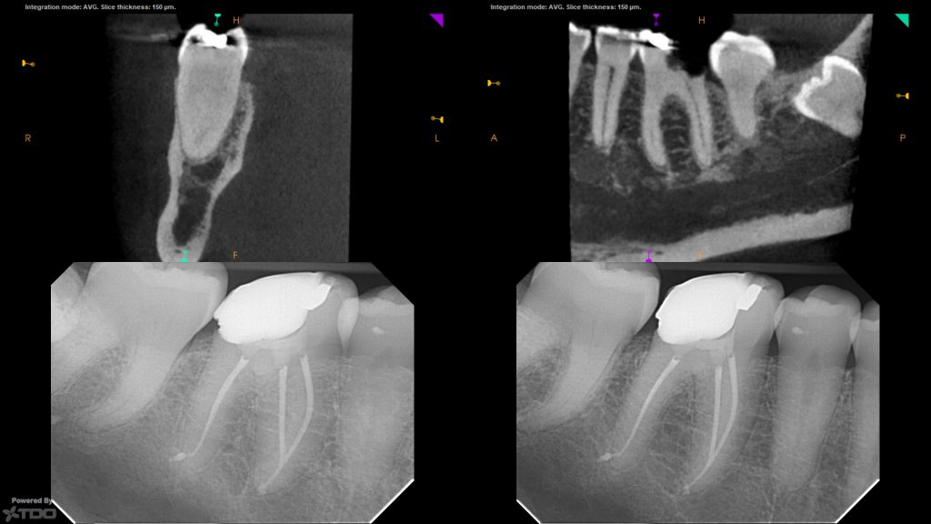 Root Canal Treatment on a Severely Calcified Tooth - Lake Washington Endo